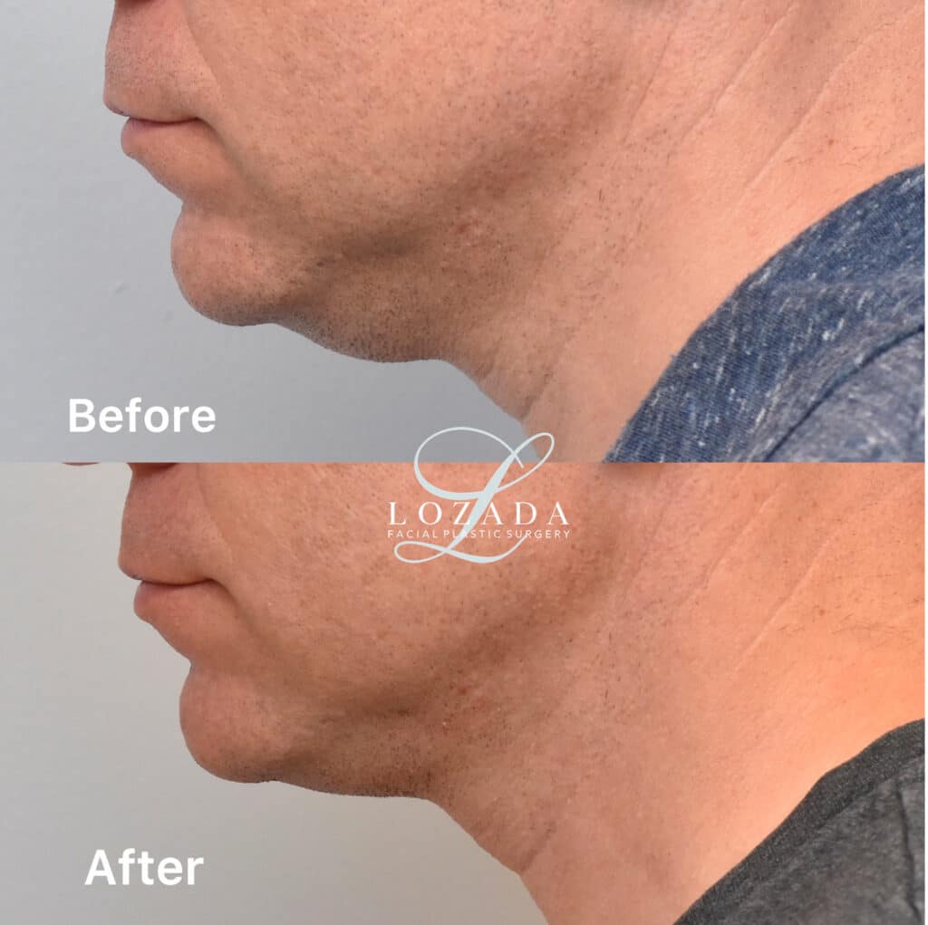Before and After Photos - Lozada Facial Plastic Surgery | Philadelphia
