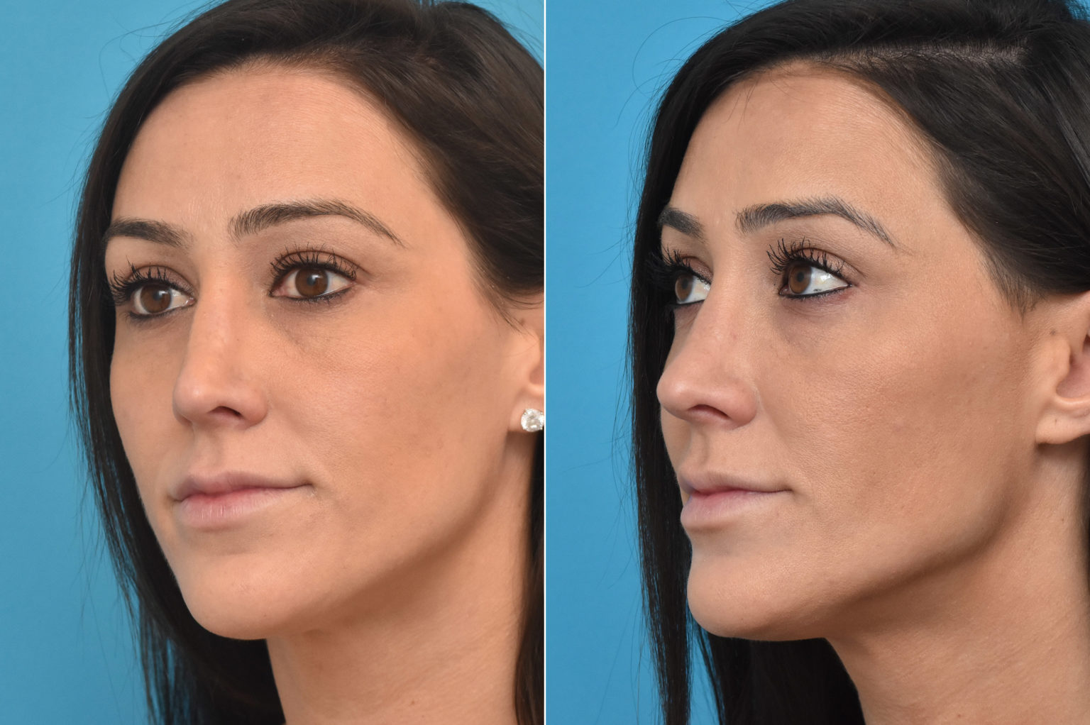 Injectable Fillers photos | Philadelphia, PA | Patient 1326