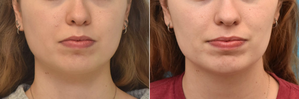 Buccal Fat Removal Philadelphia, PA | Dr. Kirk Lozada