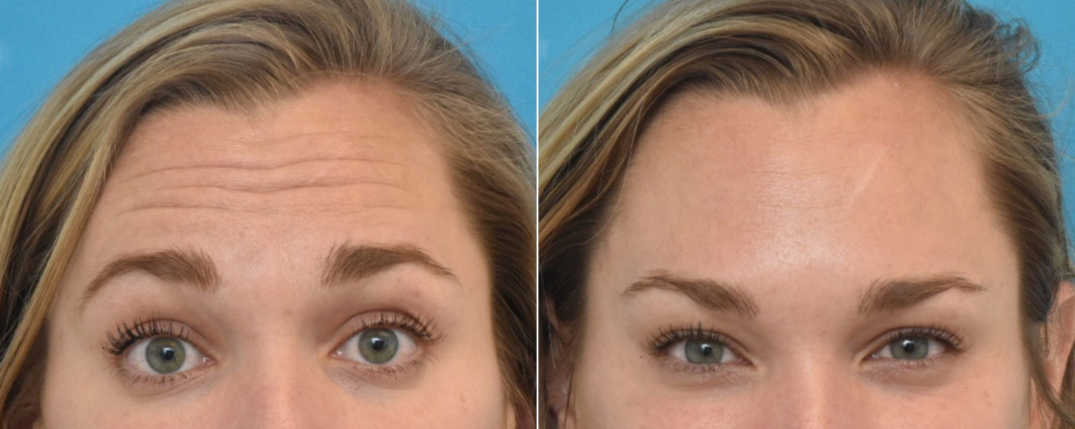 Baby Botox vs Regular Botox: Your Guide to Choosing
