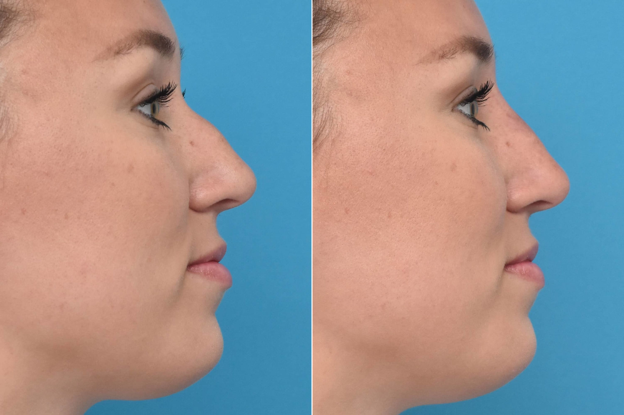 How to Fix a Crooked Nose | Surgical & Non-Surgical Options