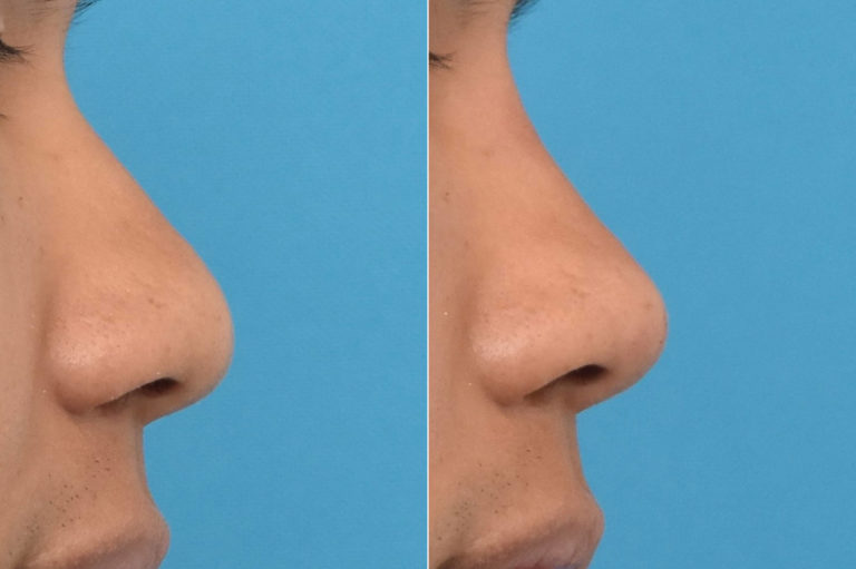 Non-Surgical Nose Tip Lift with Dr. Kirk Lozada