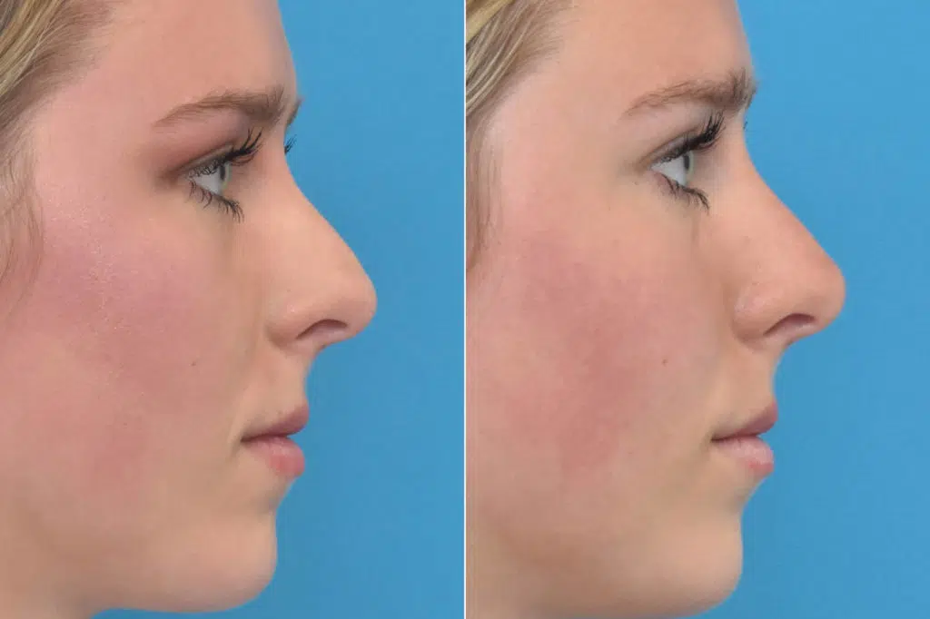 Non-Surgical Nose Tip Lift with Dr. Kirk Lozada