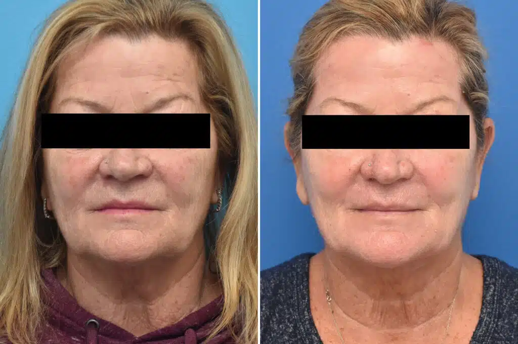 Chemical Peels Before and After photo gallery Chemical Peels Before and After photo gallery