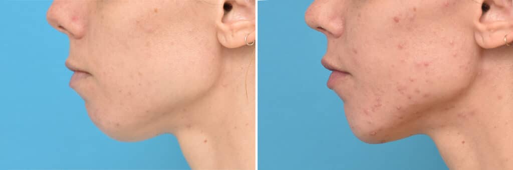 Custom Chin Implants: Are They Your Best Choice? | Dr. Lozada