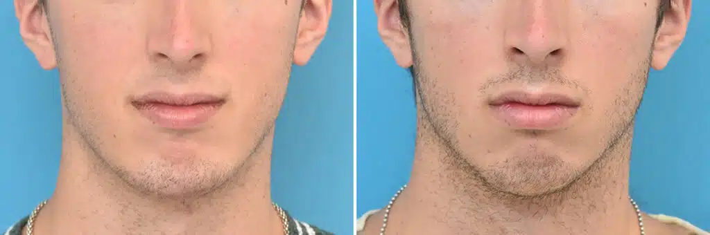 Chin Implants vs Jaw Surgery: Making the Right Choice