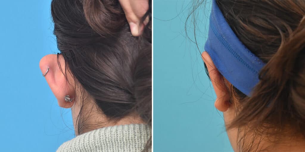 Otoplasty Philadelphia | Ear Pinning | Dr. Kirk Lozada