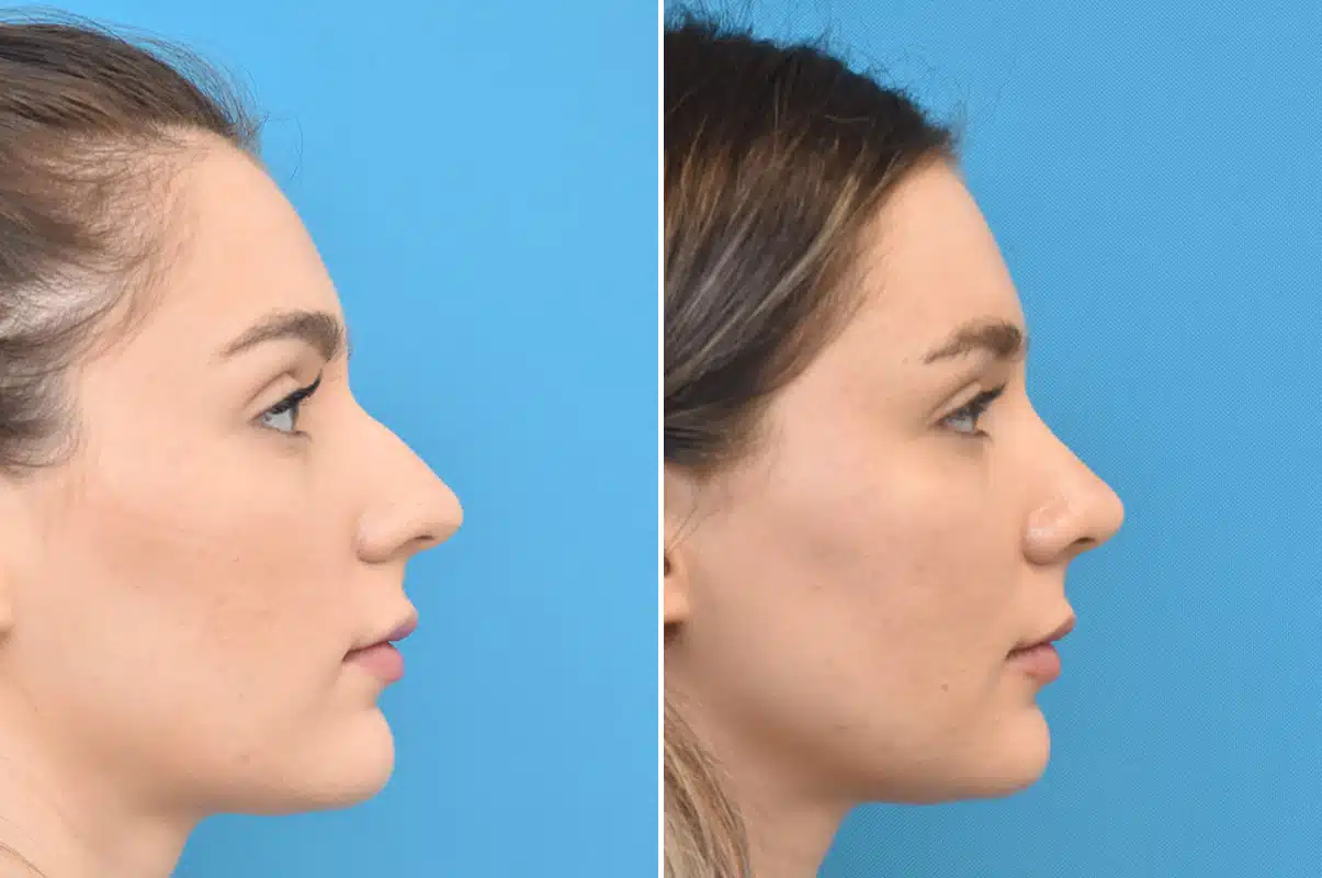 How to Fix a Crooked Nose | Surgical & Non-Surgical Options