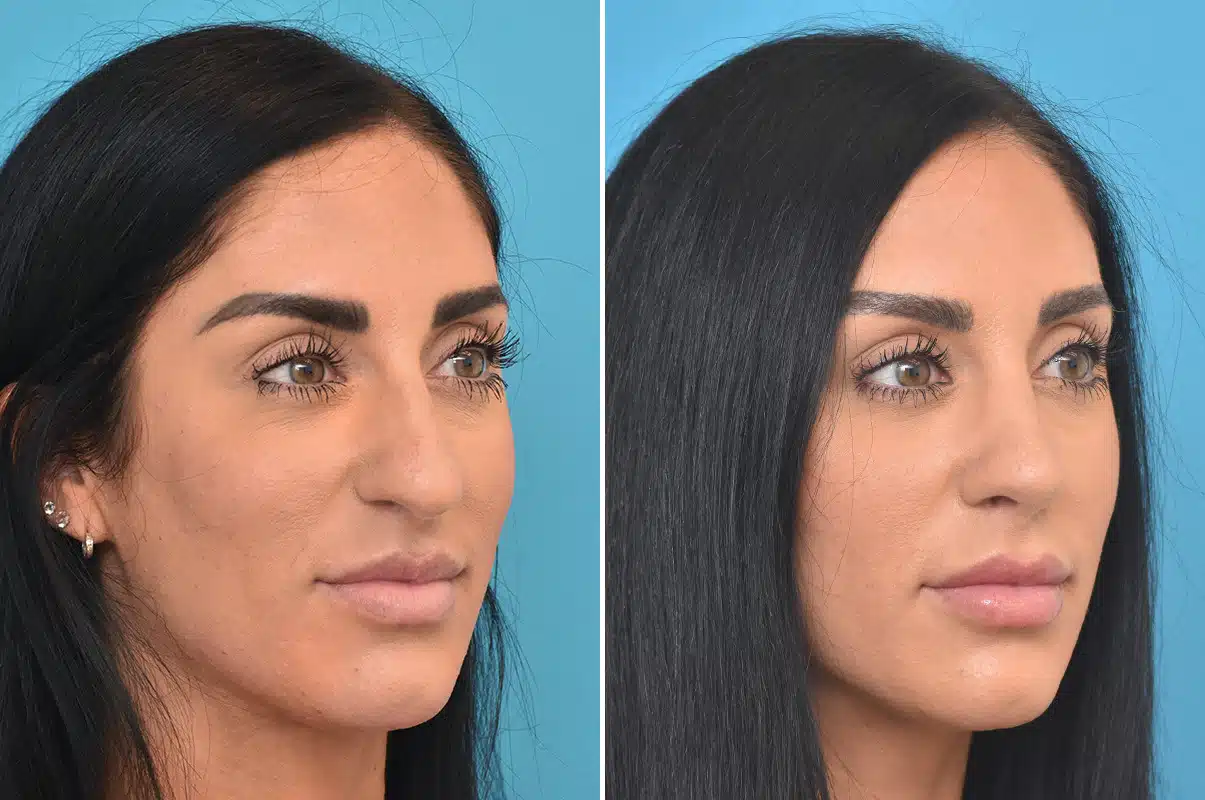 Bulbous Nose Rhinoplasty Recovery | Philadelphia, PA