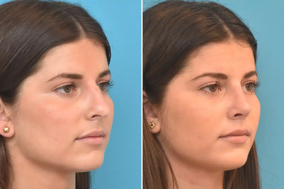 Rhinoplasty 101: Your Guide to Correcting a Crooked Nose