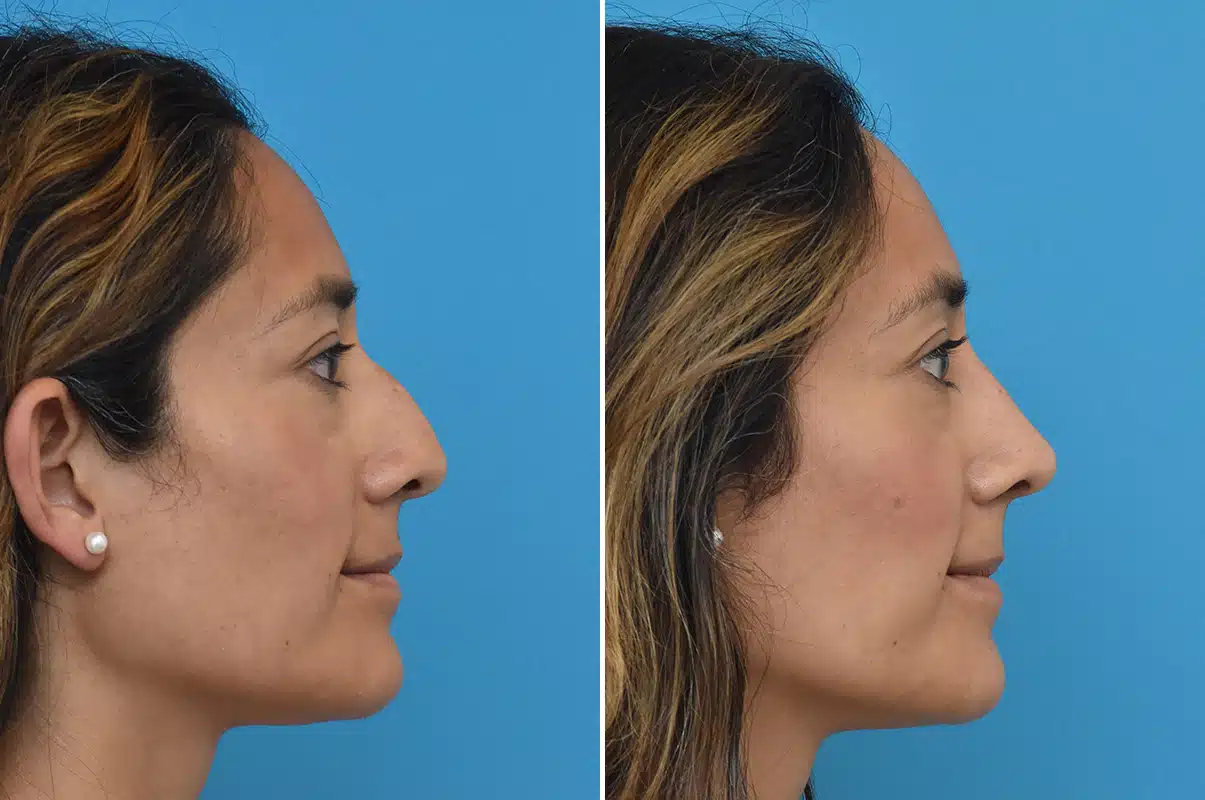 How to Fix a Crooked Nose | Surgical & Non-Surgical Options