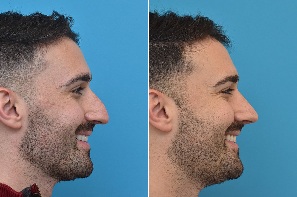 Discover Male Revision Rhinoplasty Surgery Success