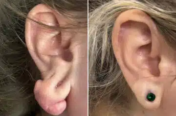 Common Causes of Earlobe Damage - Dr. Kirk Lozada