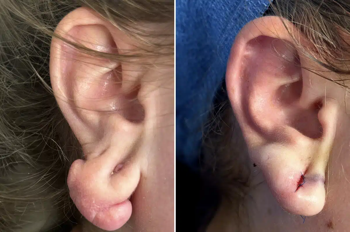 Ear Lobe Repair in Philadelphia, PA | Dr. Kirk Lozada