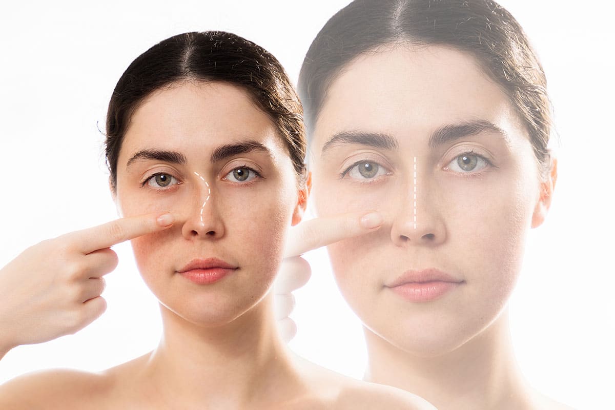 How to Fix a Crooked Nose | Surgical & Non-Surgical Options